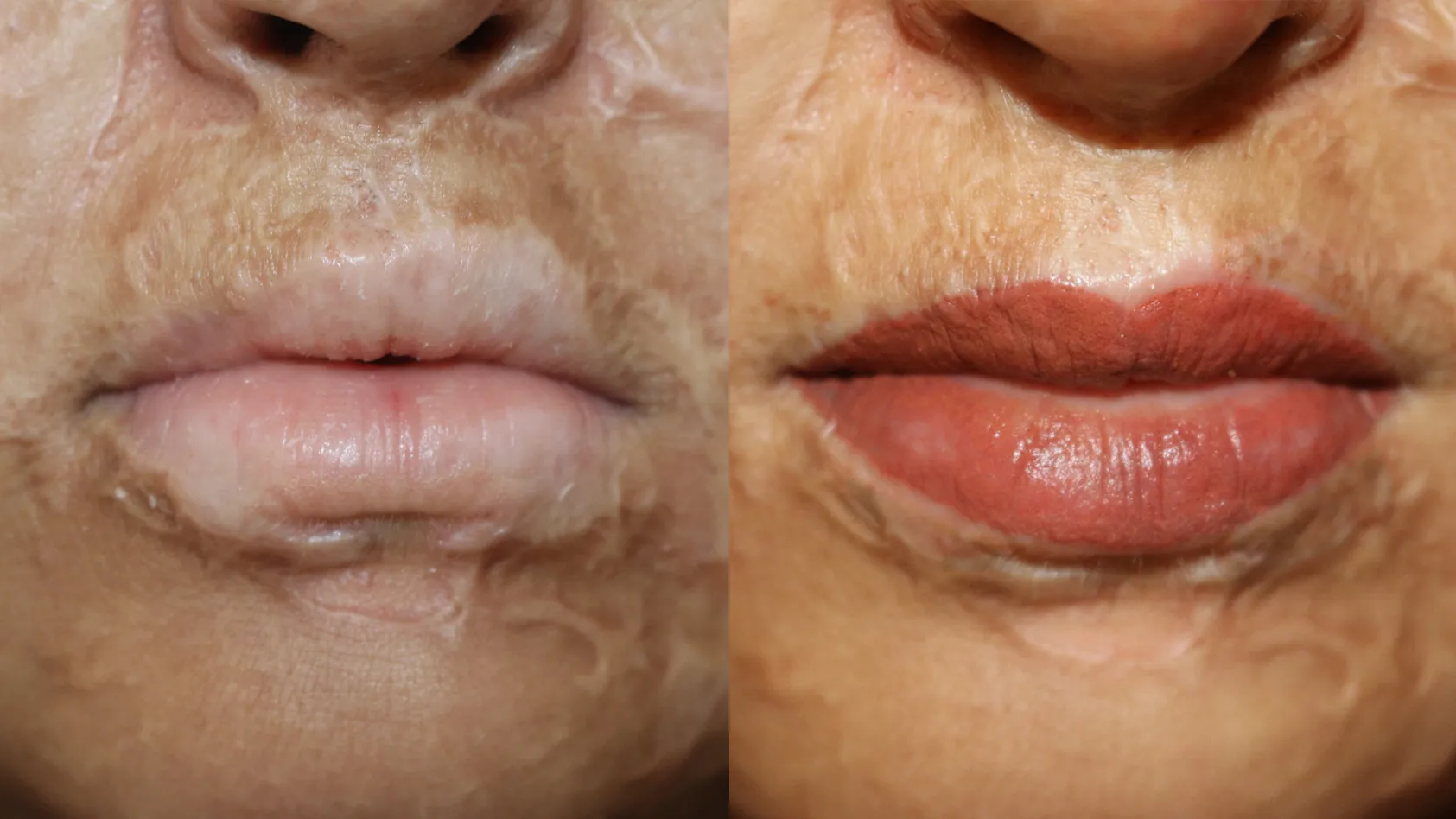 What Is Medical Tattooing? Everything You Need To Know